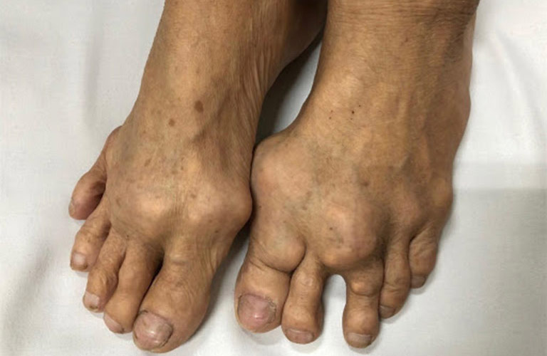 Tìm Hiểu Về Gout Mãn Tính: Nguyên Nhân, Triệu Chứng Và Điều Trị